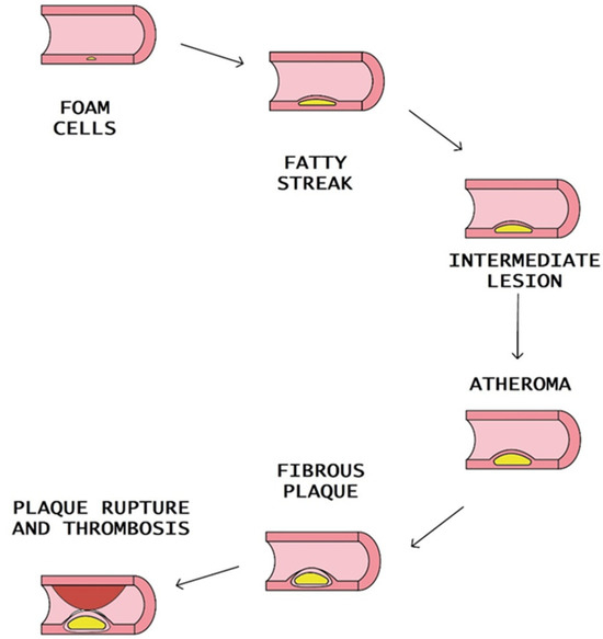Atherosclerosis and Its Related Laboratory Biomarkers