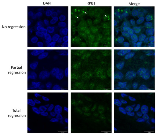 Predictive Potential of RNA Polymerase B (II) Subunit 1 (RPB1 ...