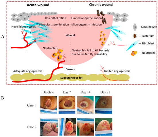 Cold Atmospheric Pressure Plasma: A Growing Paradigm in Diabetic Wound ...