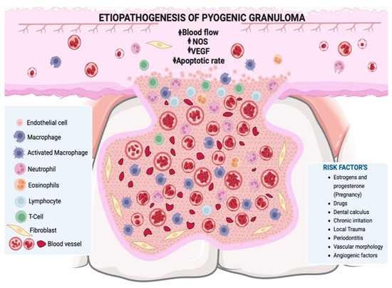 Oral Pyogenic Granuloma: A Narrative Review