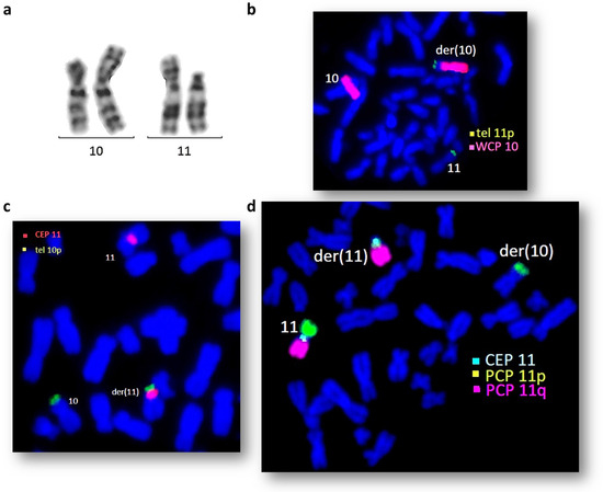 Complex Chromosomal Rearrangement Involving Chromosomes 10 and 11 ...