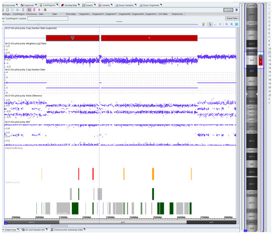 Complex Chromosomal Rearrangement Involving Chromosomes 10 and 11 ...