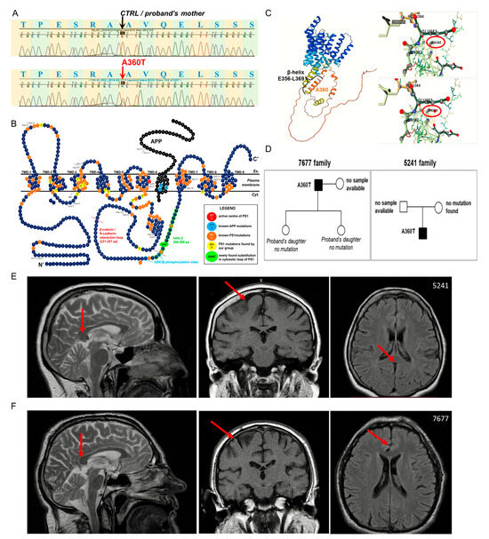 IJMS | Free Full-Text | Rare A360T Mutation Alters GSK3β(Ser9) Binding in the Cytosolic Loop of ...