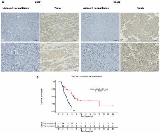 Predictive Roles of ADAM17 in Patient Survival and Immune Cell ...