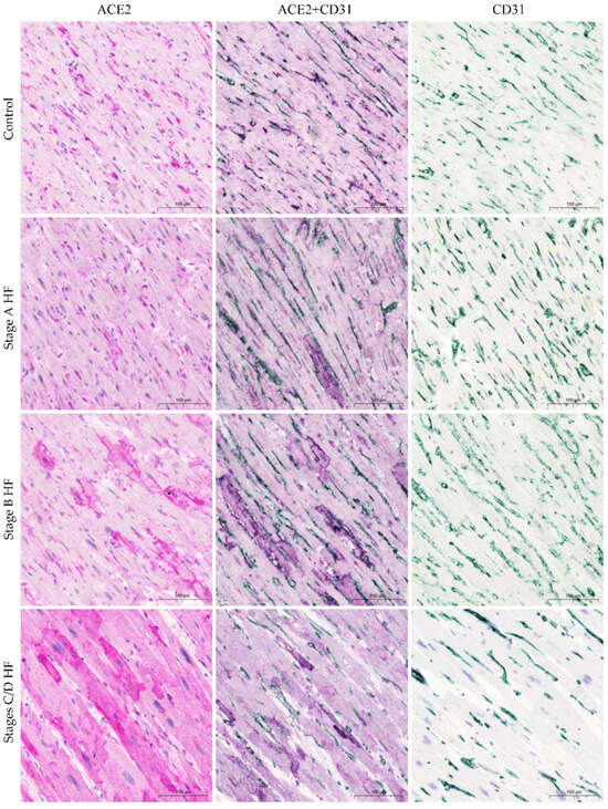 Myocardial Angiotensin-Converting Enzyme 2 Protein Expression in ...