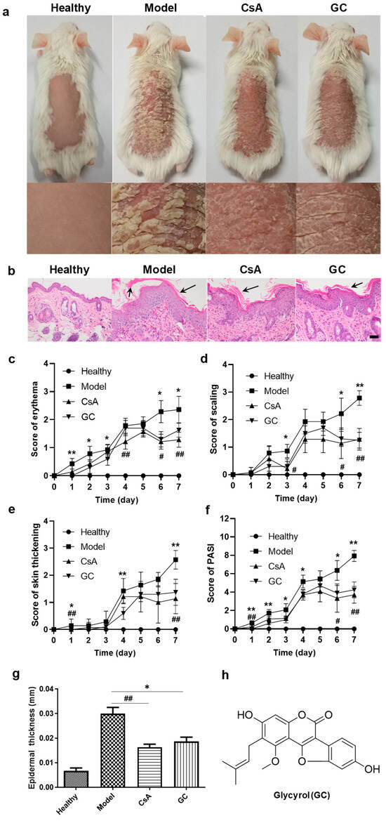 Glycyrol Prevents the Progression of Psoriasis-like Skin Inflammation ...