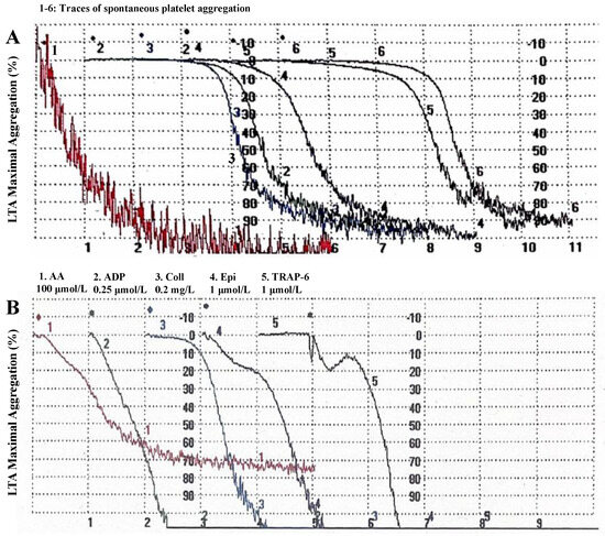 Aberrant Platelet Aggregation as Initial Presentation of Essential ...