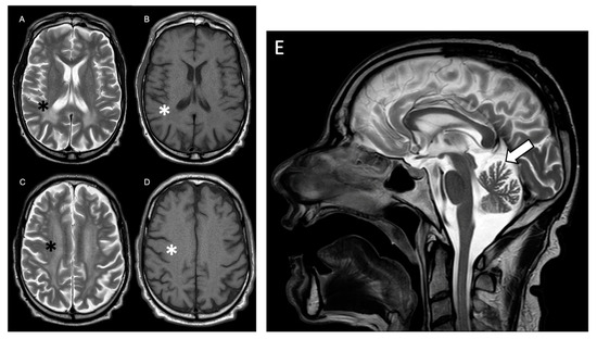 Triple Genetic Diagnosis in a Patient with Late-Onset Leukodystrophy ...