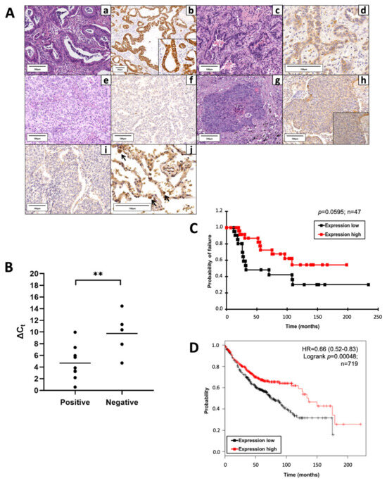 Proline Dehydrogenase (PRODH) Is Expressed in Lung Adenocarcinoma and ...