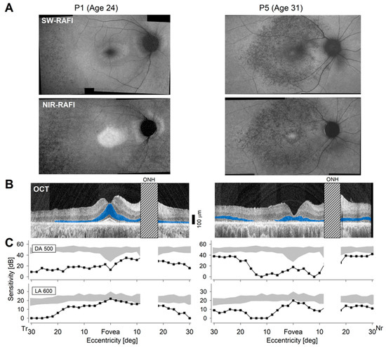Inherited Retinal Degeneration Caused by Dehydrodolichyl Diphosphate ...