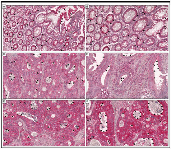A Prognostic Activity of Glutaredoxin 1 Protein (Grx1) in Colon Cancer