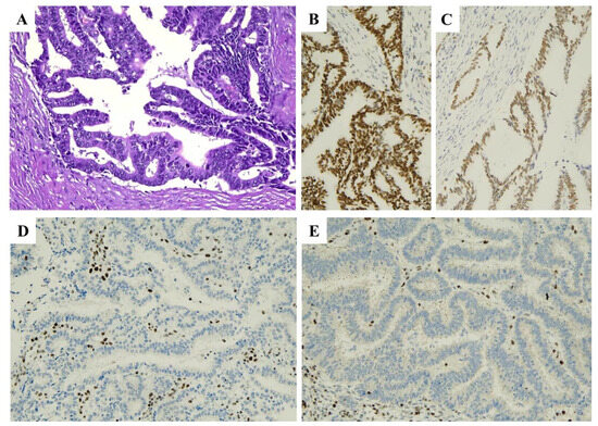 IJMS | Free Full-Text | Mismatch Repair Deficiency as a Predictive and ...
