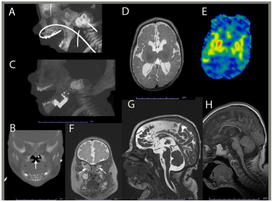 Dysfunctional Postnatal Mitochondrial Energy Metabolism in a Patient ...