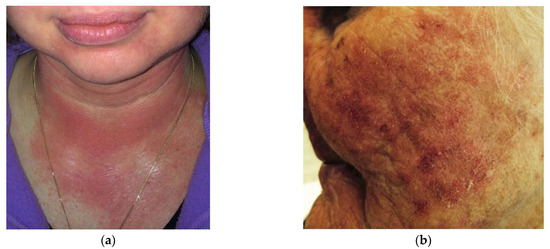 Skin Protection by Carotenoid Pigments