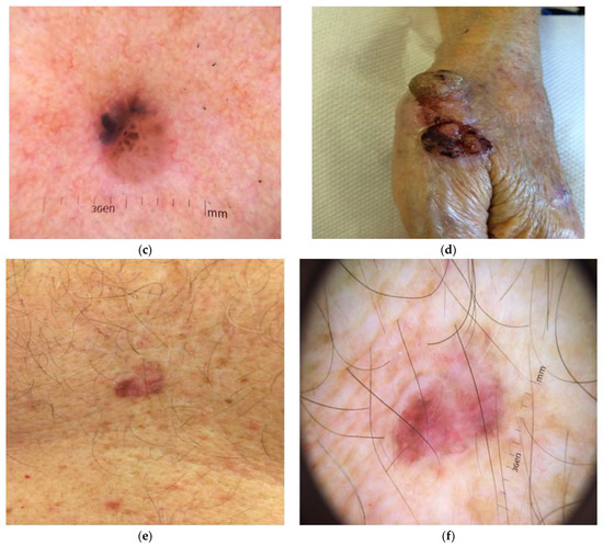 Skin Protection by Carotenoid Pigments