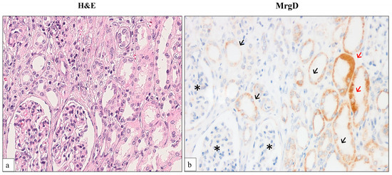 The Expression of Alamandine Receptor MrgD in Clear Cell Renal Cell ...