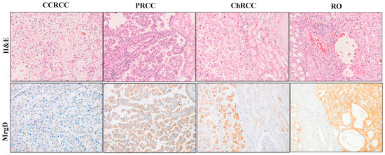 The Expression of Alamandine Receptor MrgD in Clear Cell Renal Cell ...