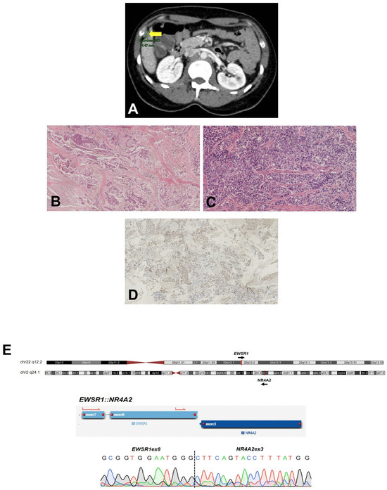 Identification of Novel/Rare EWSR1 Fusion Partners in Undifferentiated ...