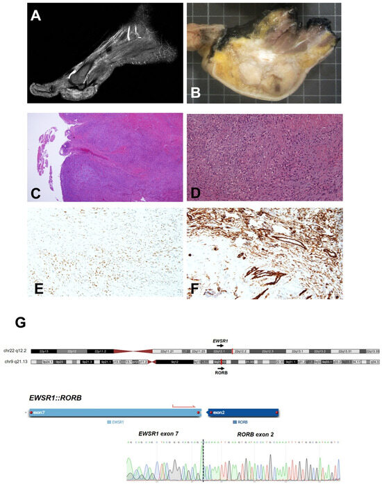 Identification of Novel/Rare EWSR1 Fusion Partners in Undifferentiated ...