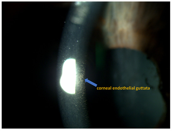 Fuch’s Endothelial Corneal Dystrophy in Cataract Patients Is Associated ...