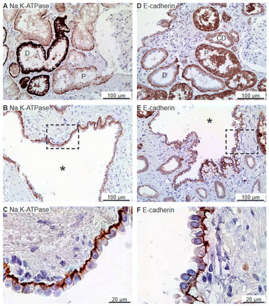 The Cyst Epithelium in Polycystic Kidney Disease Patients Displays ...