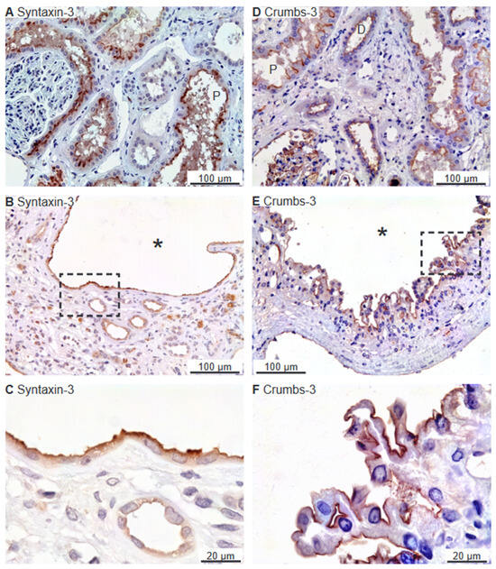 The Cyst Epithelium in Polycystic Kidney Disease Patients Displays ...