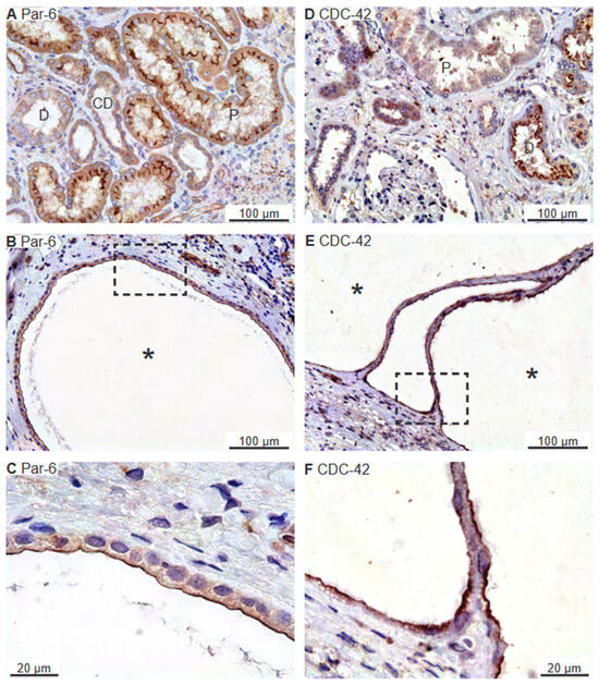 The Cyst Epithelium in Polycystic Kidney Disease Patients Displays ...