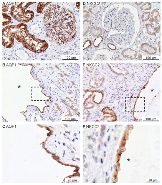 The Cyst Epithelium in Polycystic Kidney Disease Patients Displays ...