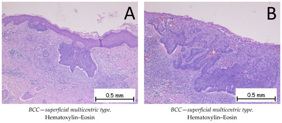 Pathophysiology, Histopathology, and Differential Diagnostics of Basal ...