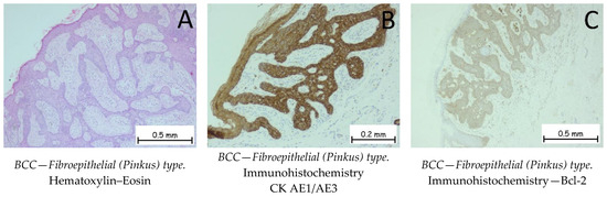 Pathophysiology, Histopathology, and Differential Diagnostics of Basal ...