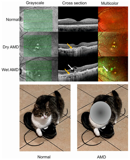 A New Generation of Gene Therapies as the Future of Wet AMD Treatment