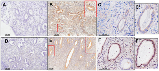 Prefoldin-5 Expression Is Elevated in Eutopic and Ectopic Endometriotic ...