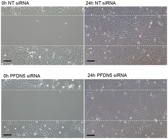 Prefoldin-5 Expression Is Elevated in Eutopic and Ectopic Endometriotic ...