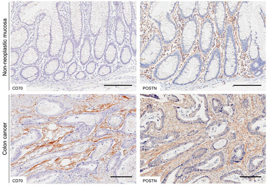 Simultaneous Expression of CD70 and POSTN in Cancer-Associated ...