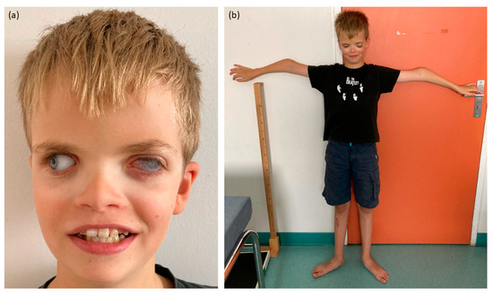 Structural Variant Disrupting the Expression of the Remote FOXC1 Gene ...