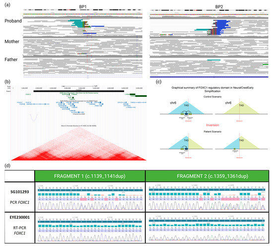 Structural Variant Disrupting the Expression of the Remote FOXC1 Gene ...