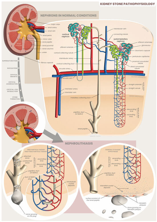 Pathophysiology and Main Molecular Mechanisms of Urinary Stone ...