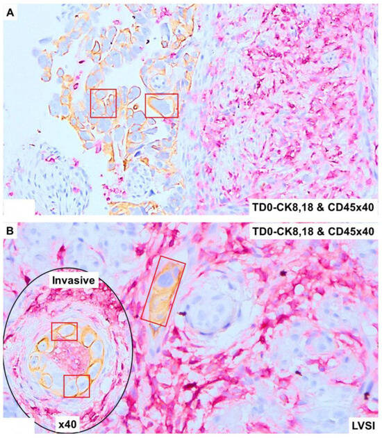 Atlas of Tumor and Tumor Microenvironment Cells of Lymphovascular Space ...
