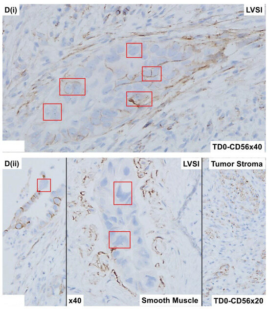 Atlas of Tumor and Tumor Microenvironment Cells of Lymphovascular Space ...