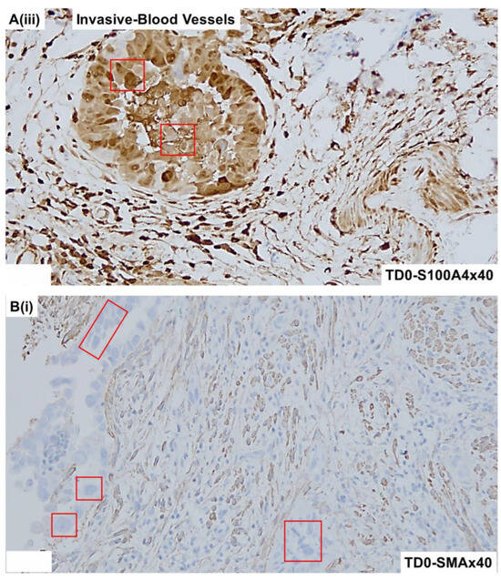 Atlas of Tumor and Tumor Microenvironment Cells of Lymphovascular Space ...