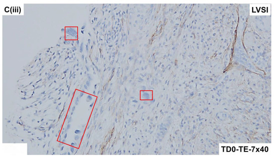 Atlas of Tumor and Tumor Microenvironment Cells of Lymphovascular Space ...