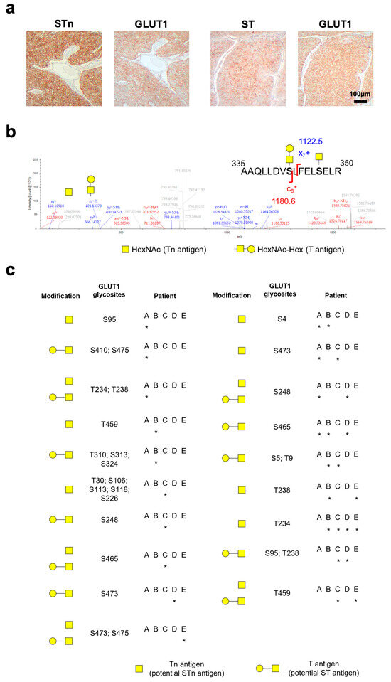 Aberrantly Glycosylated GLUT1 as a Poor Prognosis Marker in Aggressive ...