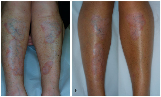 Shedding Light on Photodynamic Therapy in the Treatment of Necrobiosis ...