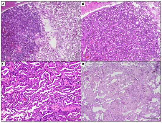 Multidisciplinary Approach to the Diagnosis of Idiopathic Interstitial ...