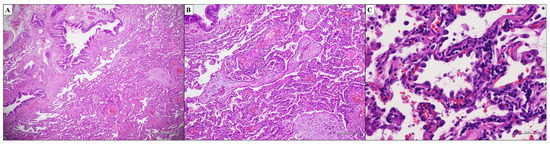 Multidisciplinary Approach to the Diagnosis of Idiopathic Interstitial ...