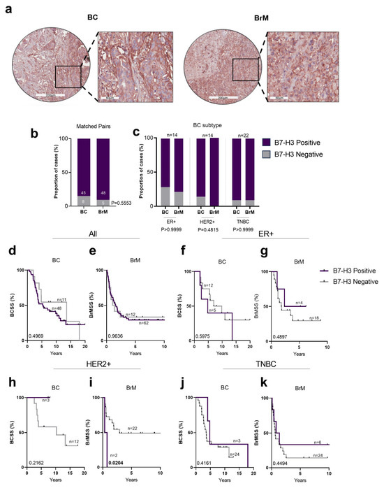 B7-H3 Expression in Breast Cancer and Brain Metastasis