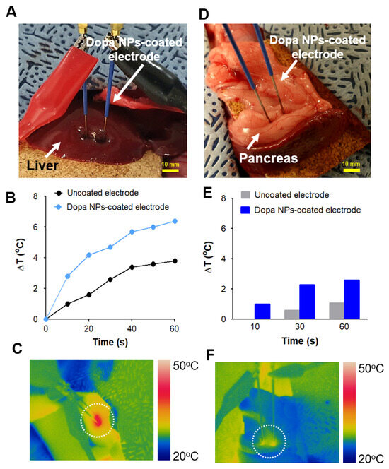 The Induction of Combined Hyperthermal Ablation Effect of Irreversible ...