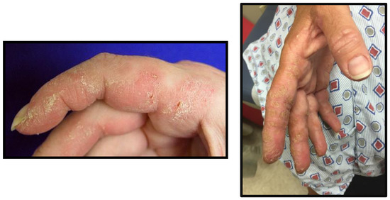 A Review of Antisynthetase Syndrome-Associated Interstitial Lung Disease