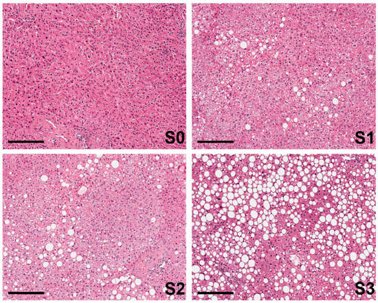 Drug-Induced Fatty Liver Disease (DIFLD): A Comprehensive Analysis of ...
