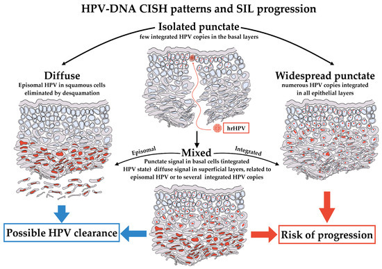 High-Risk HPV CISH Detection in Cervical Biopsies with Weak and/or ...